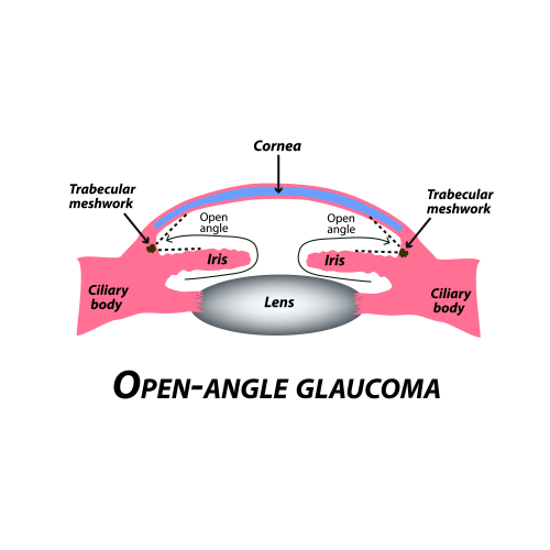 Why Durysta May Be a Good Treatment if You Have Glaucoma | See Clearly ...